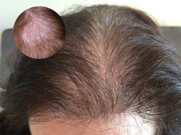 Nấm da đầu: Nguyên nhân, dấu hiệu, điều trị và phòng ngừa chuẩn y khoa ...